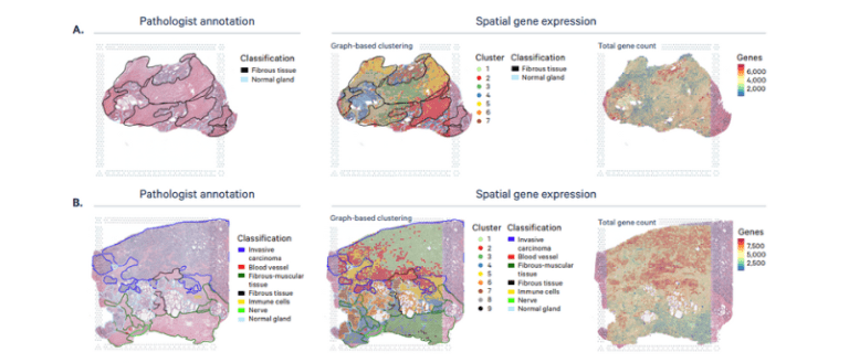 Enriching pathological analysis of FFPE tumor samples with spatial ... Enriching pathological analysis of FFPE tumor samples with spatial ...