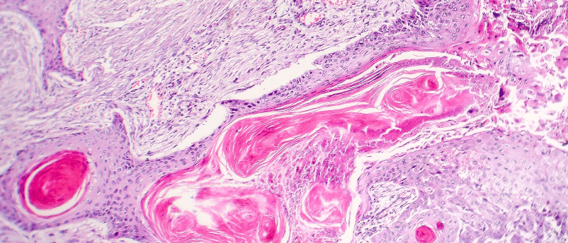 What Drives Tumors to Become Malignant? - BioTechniques