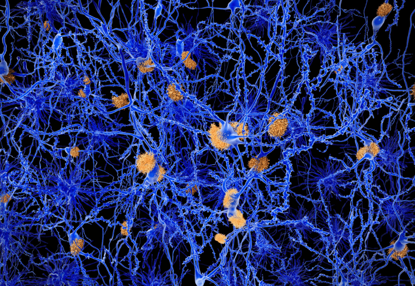 Amyloid fibrils in Alzheimer's disease visualized using gold ...